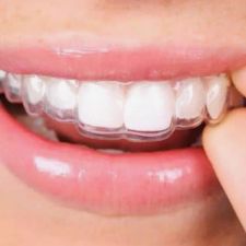 Alta Smiles Orthodontic Centers King of Prussia - 700 S Henderson Rd ...